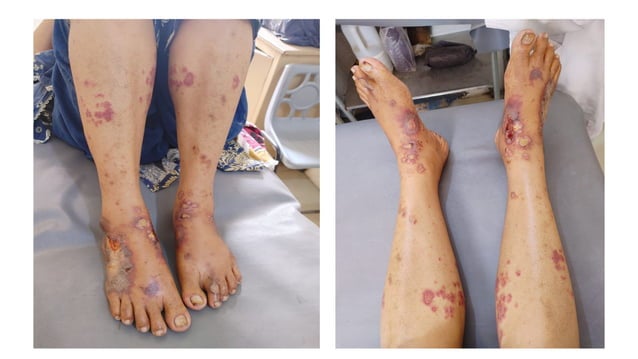 IgA vasculitis (A Case Presentation).pptx