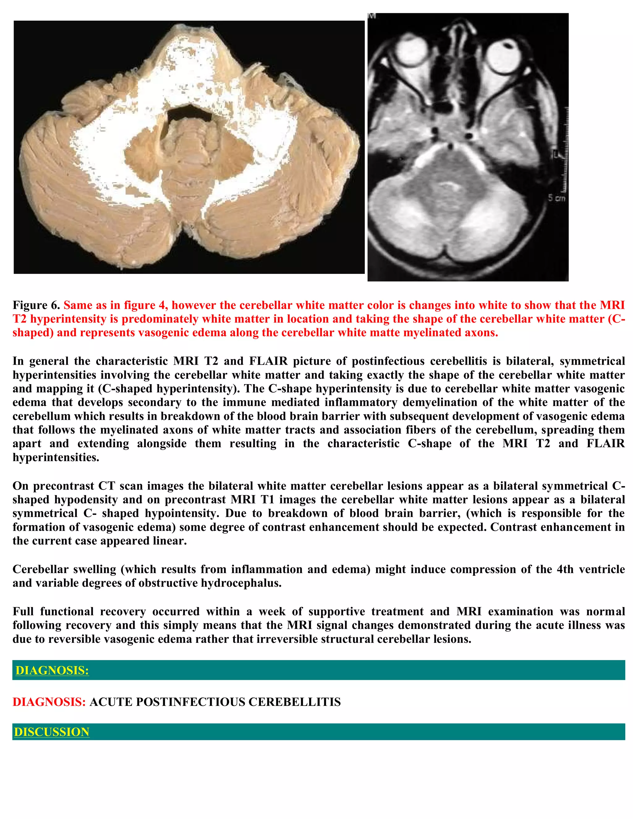 Case record...Postinfectious cerebellitis | PDF