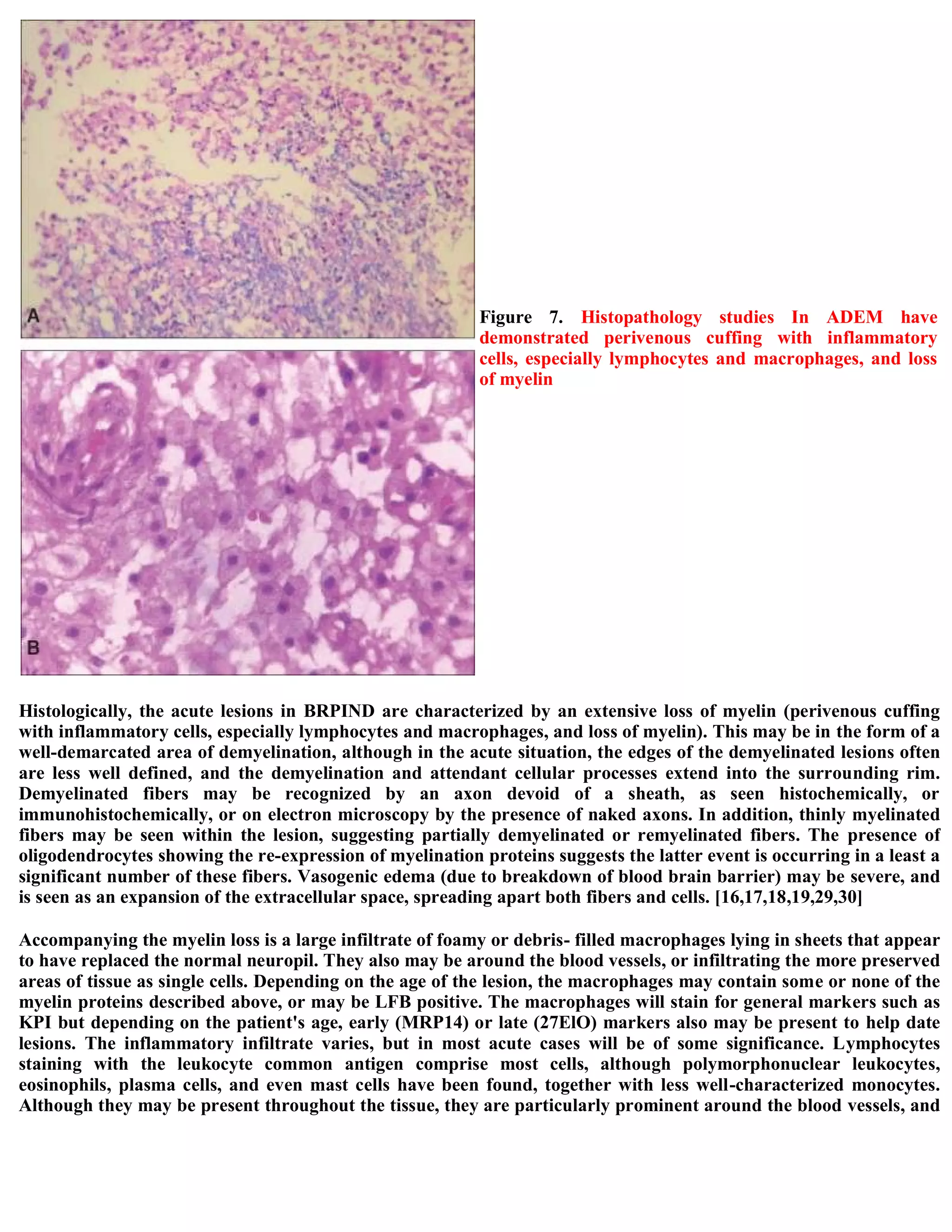 Case record...Postinfectious cerebellitis | PDF