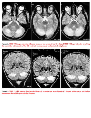 Case record...Postinfectious cerebellitis | PDF