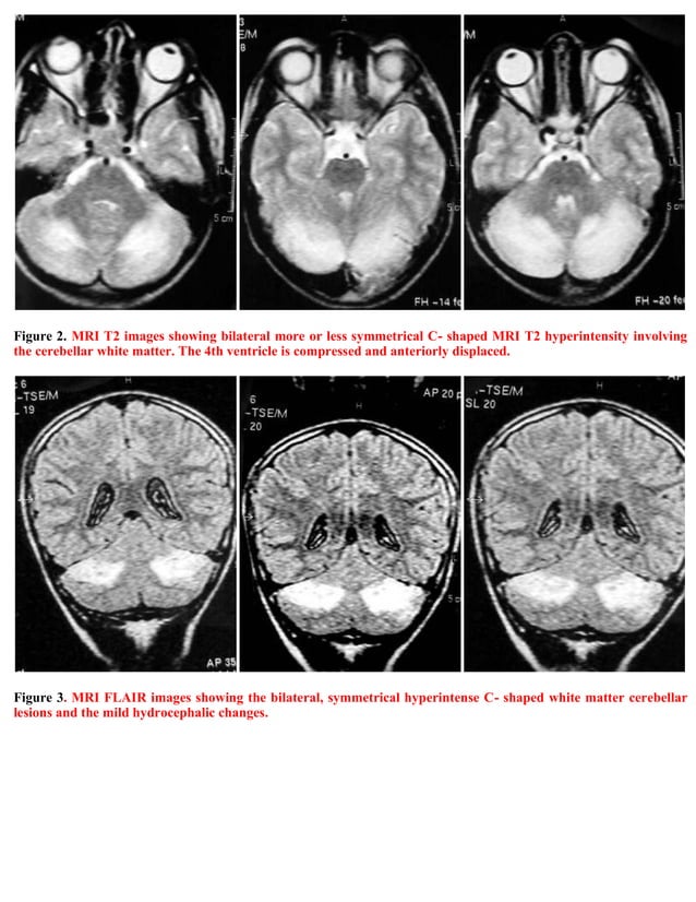 Case record...Postinfectious cerebellitis | PDF | Brain and Nervous ...