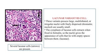 B/L Cervical Lymphadenopathy Case 29.pptx