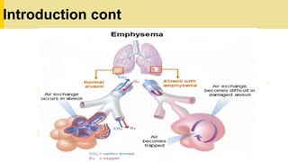 Emphysema | PPTX | Lung and Respiratory Health | Diseases and Conditions