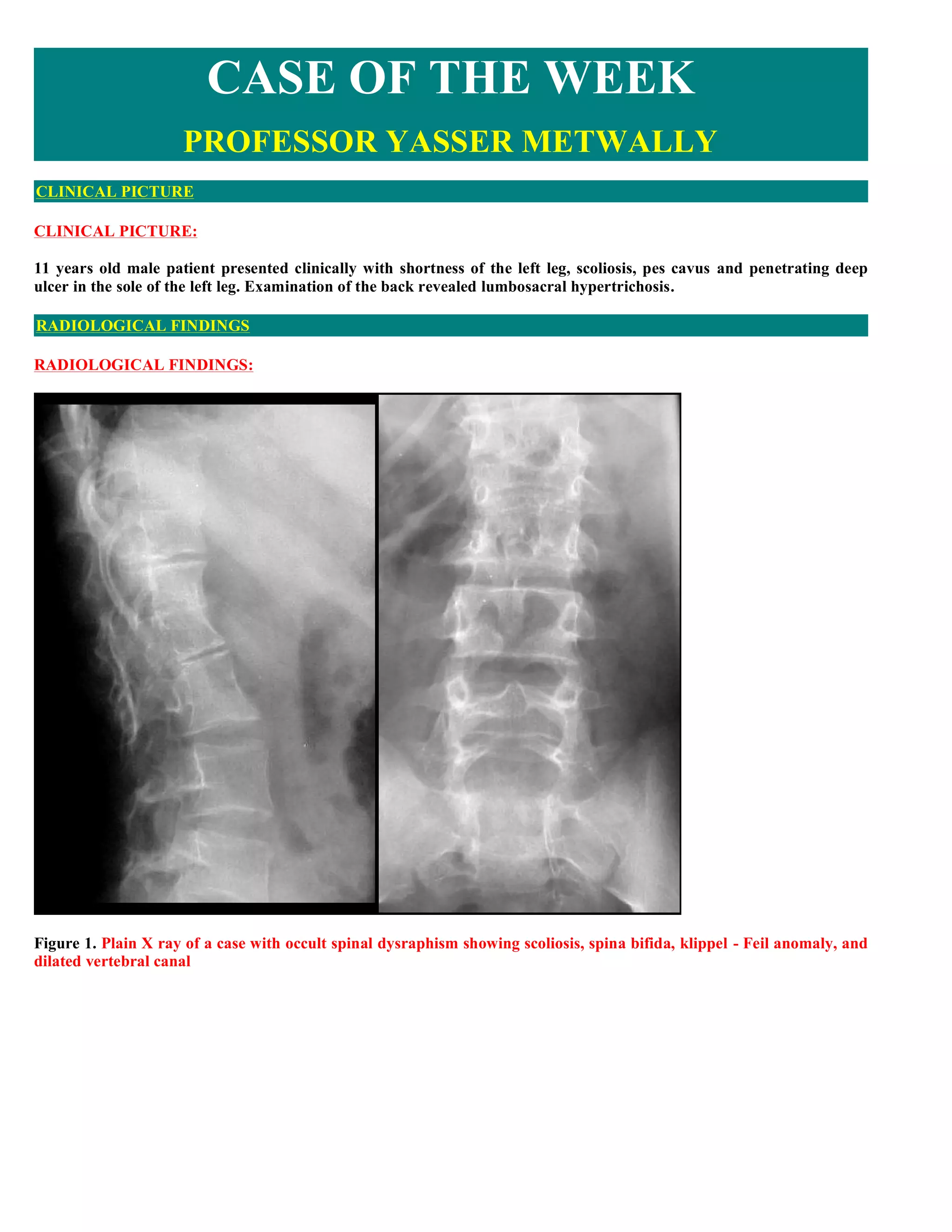 Case record... Spinal dysraphism | PDF