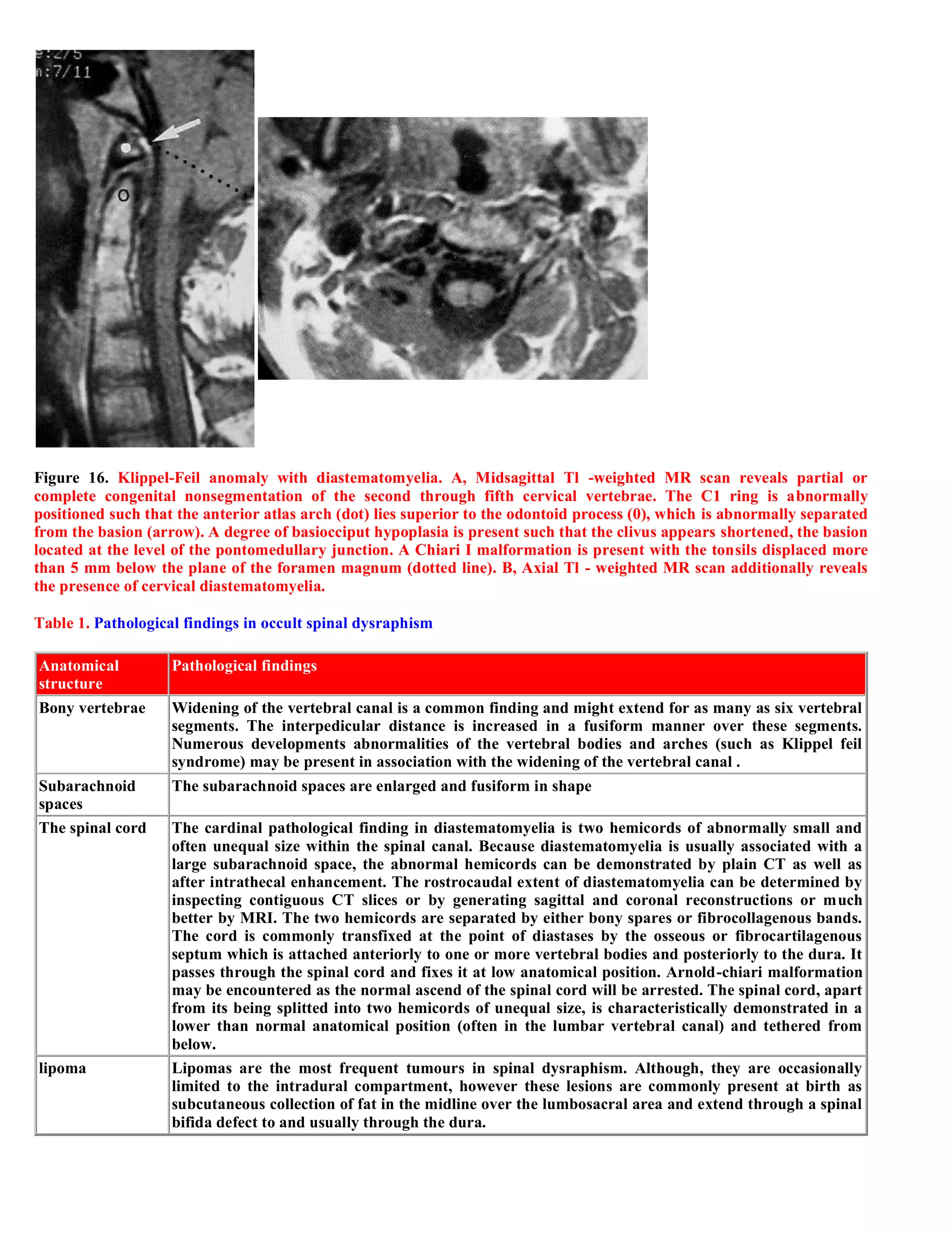 Case record... Spinal dysraphism | PDF