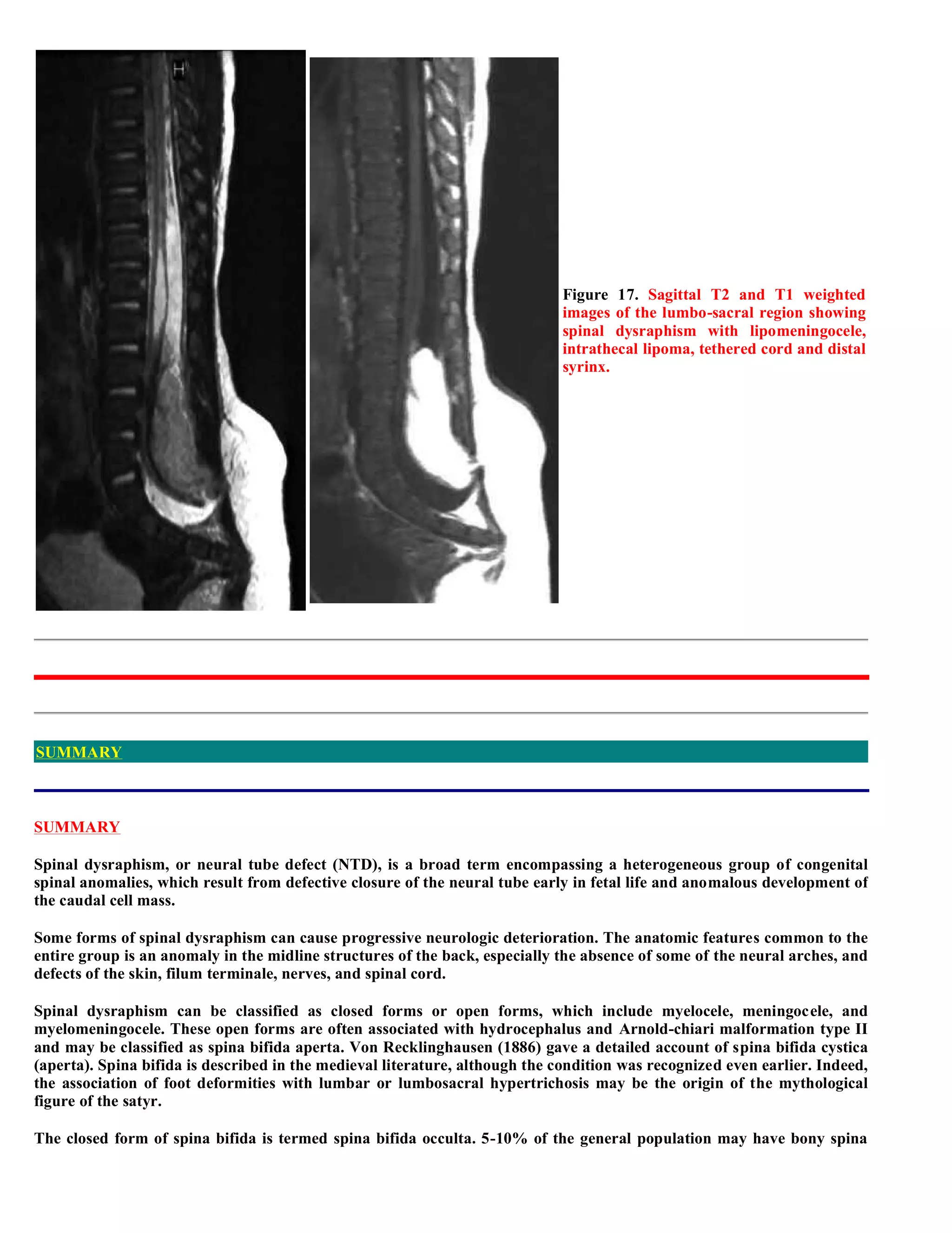 Case record... Spinal dysraphism | PDF