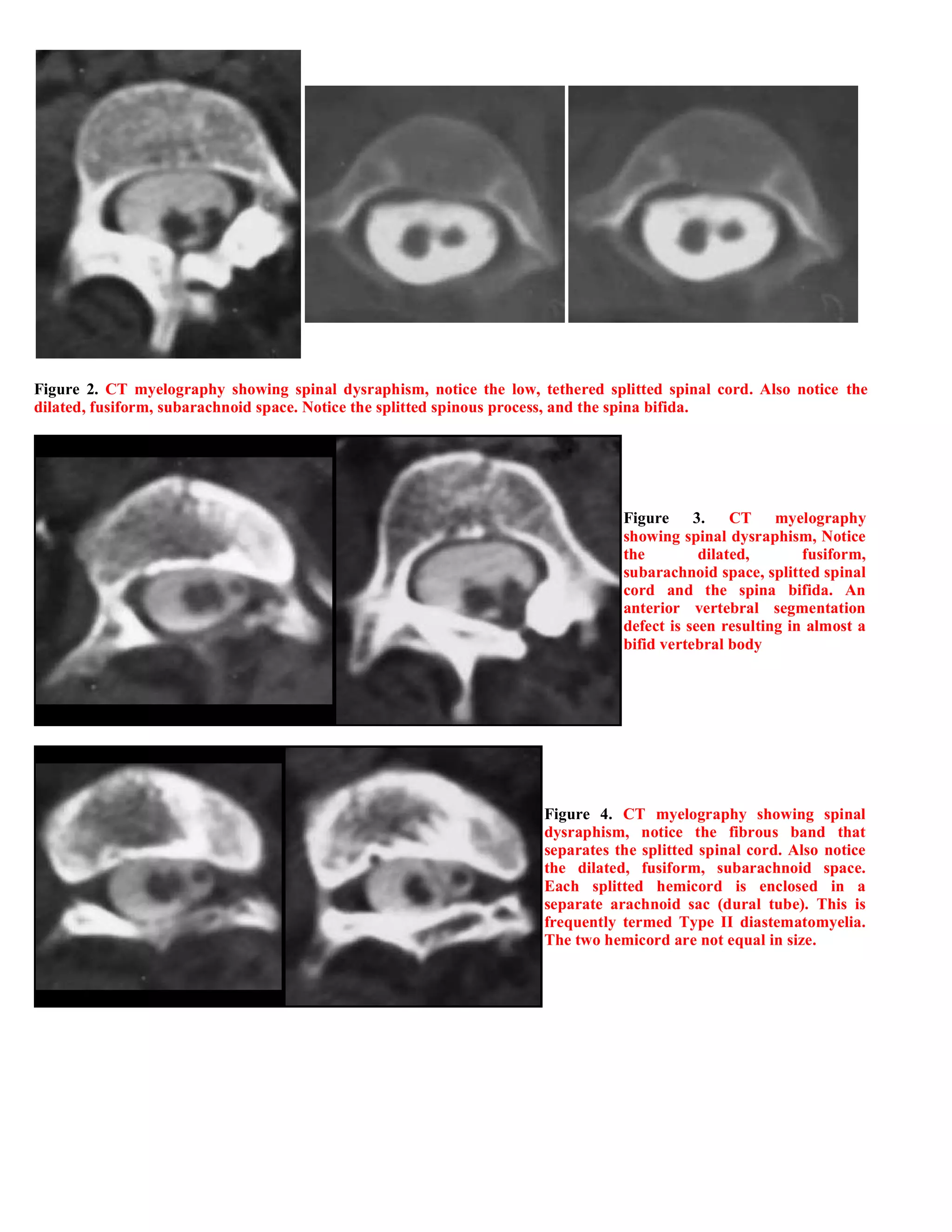 Case record... Spinal dysraphism | PDF