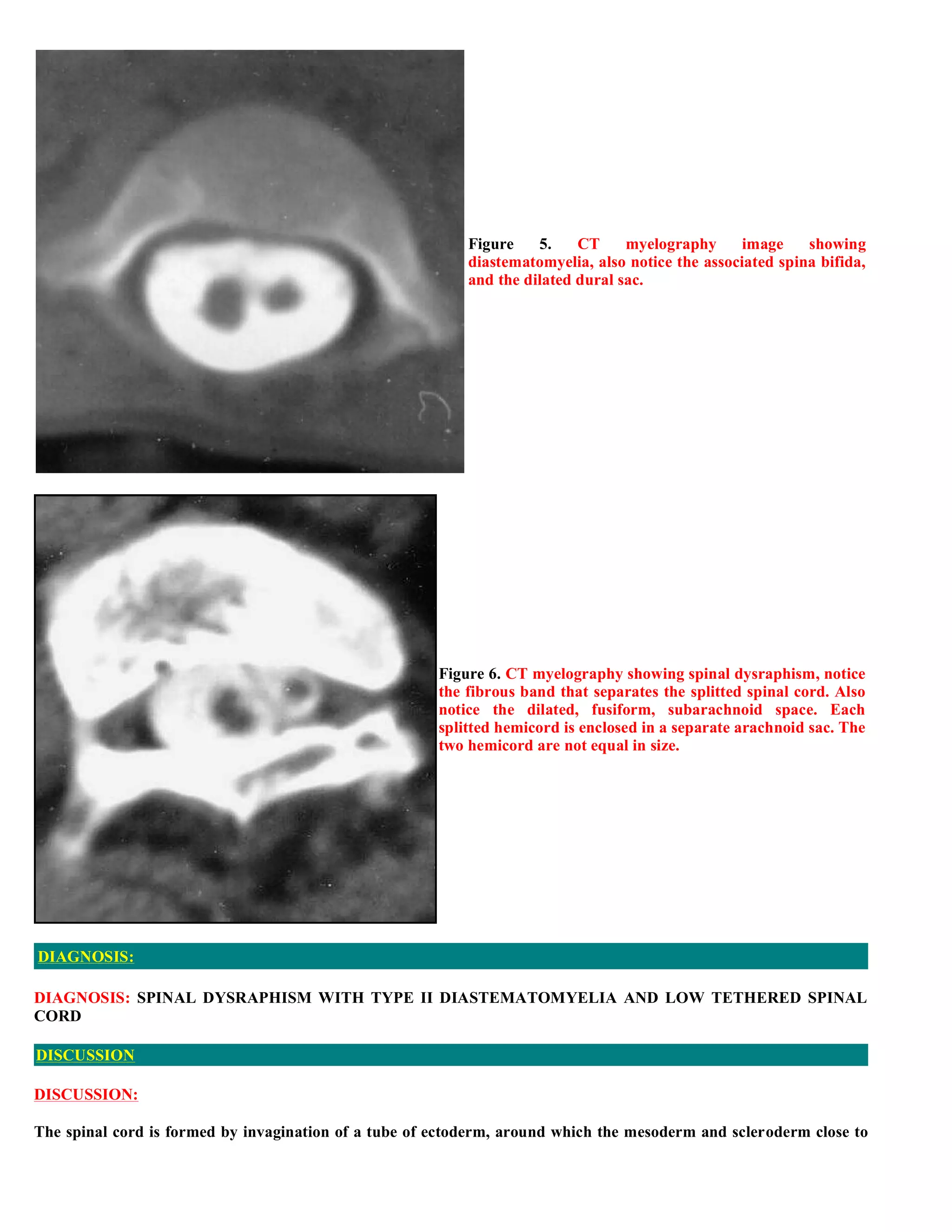 Case record... Spinal dysraphism | PDF
