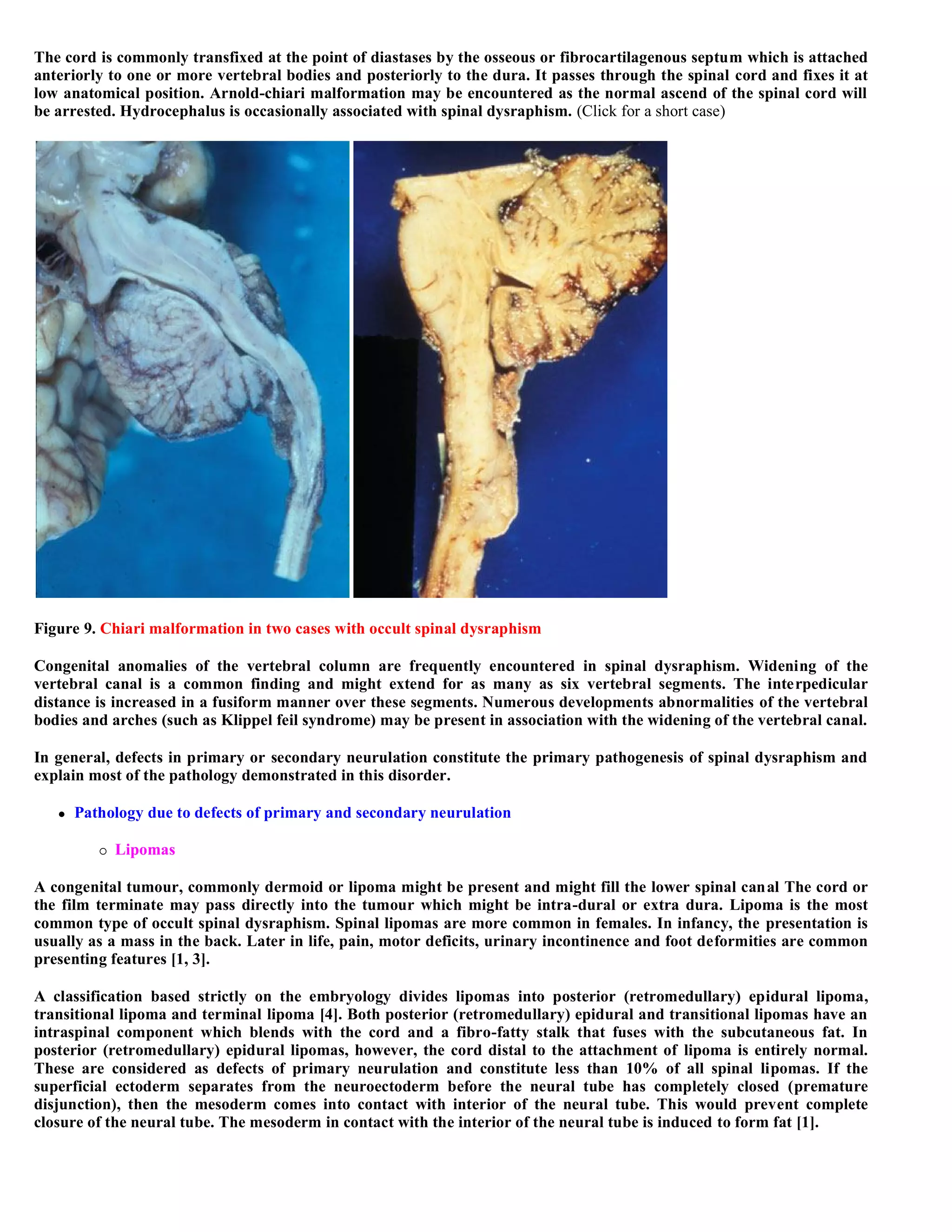 Case record... Spinal dysraphism | PDF