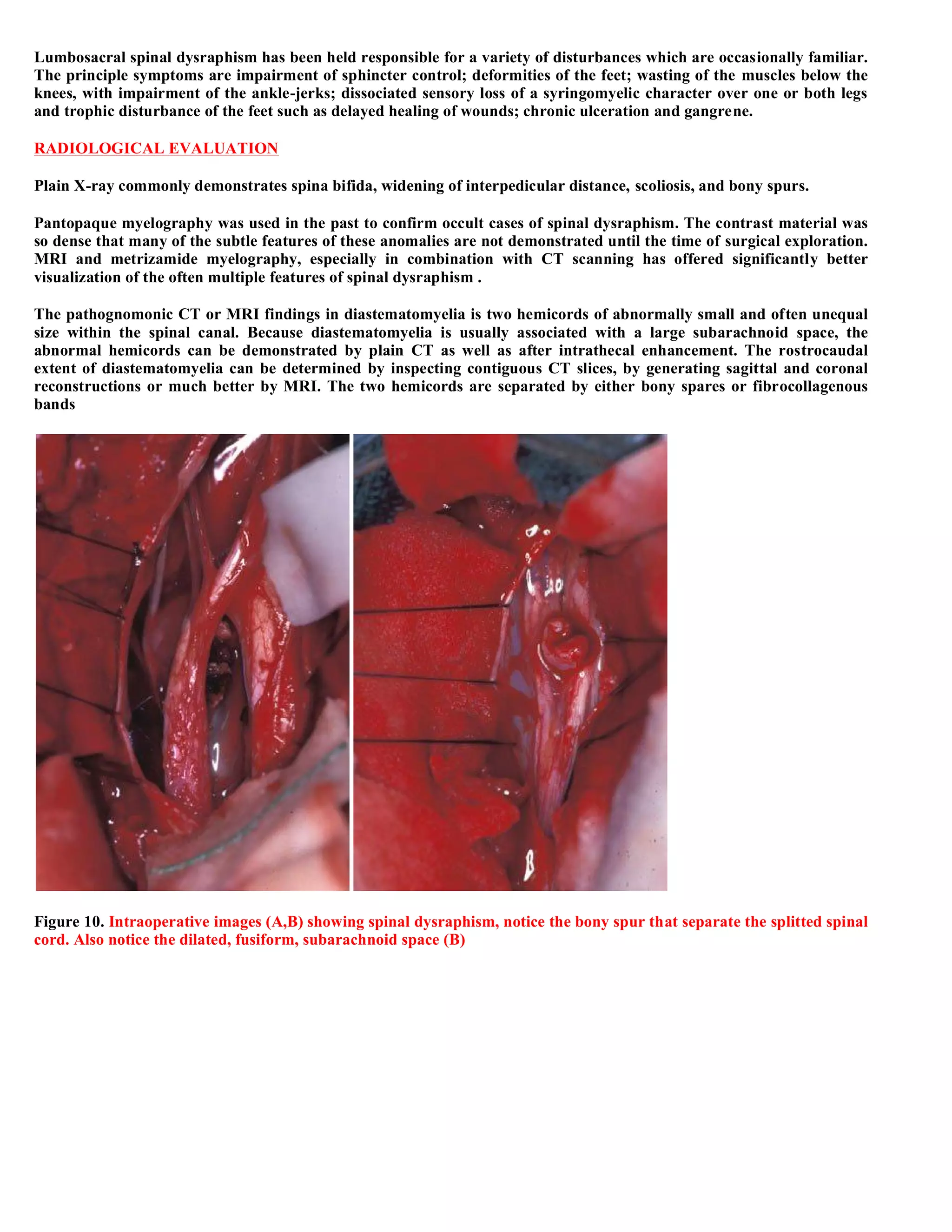 Case record... Spinal dysraphism | PDF
