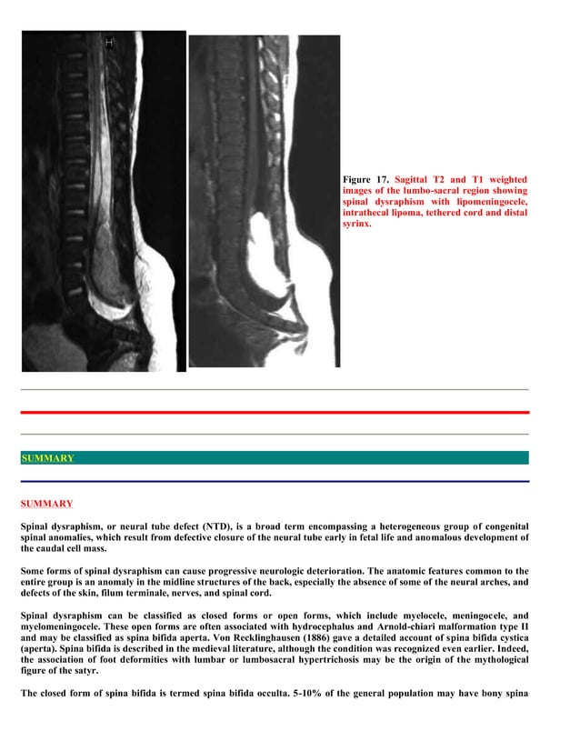 Case record... Spinal dysraphism | PDF