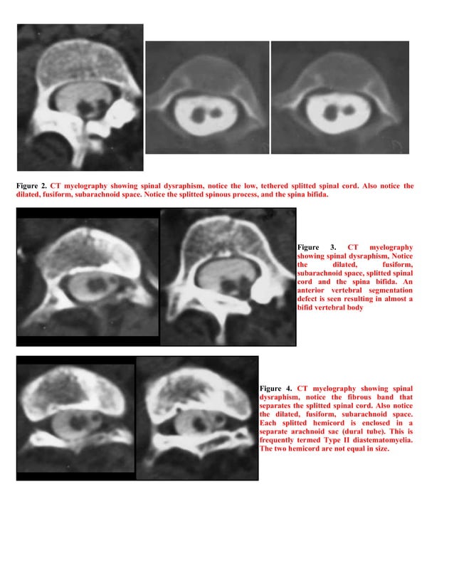 Case record... Spinal dysraphism | PDF