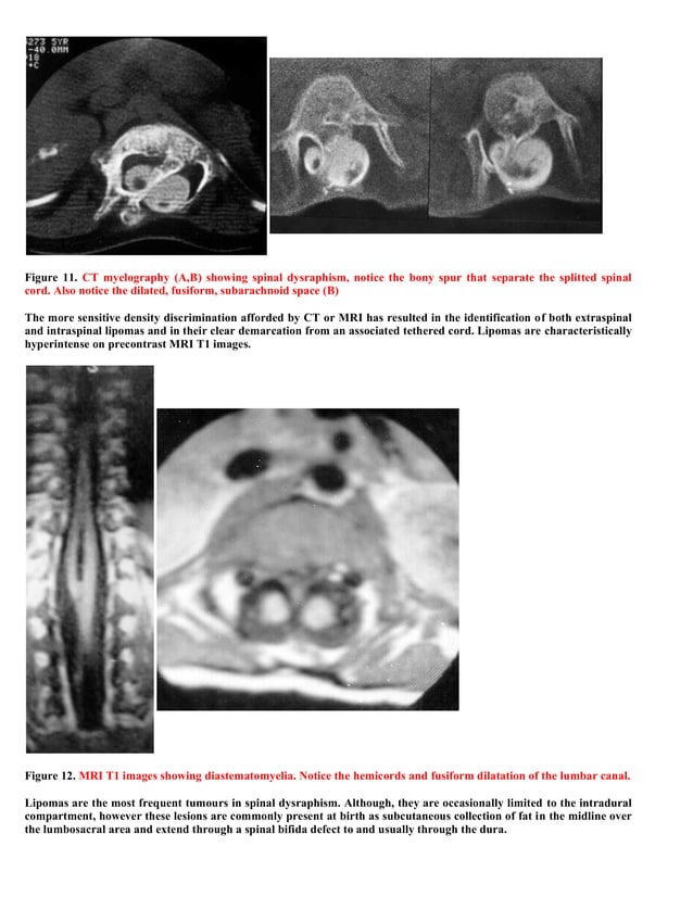 Case record... Spinal dysraphism | PDF