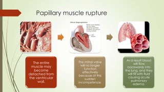 Papillary rupture | PPTX