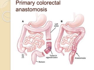 Anastomotic leak following colorectal resection - case study | PPT