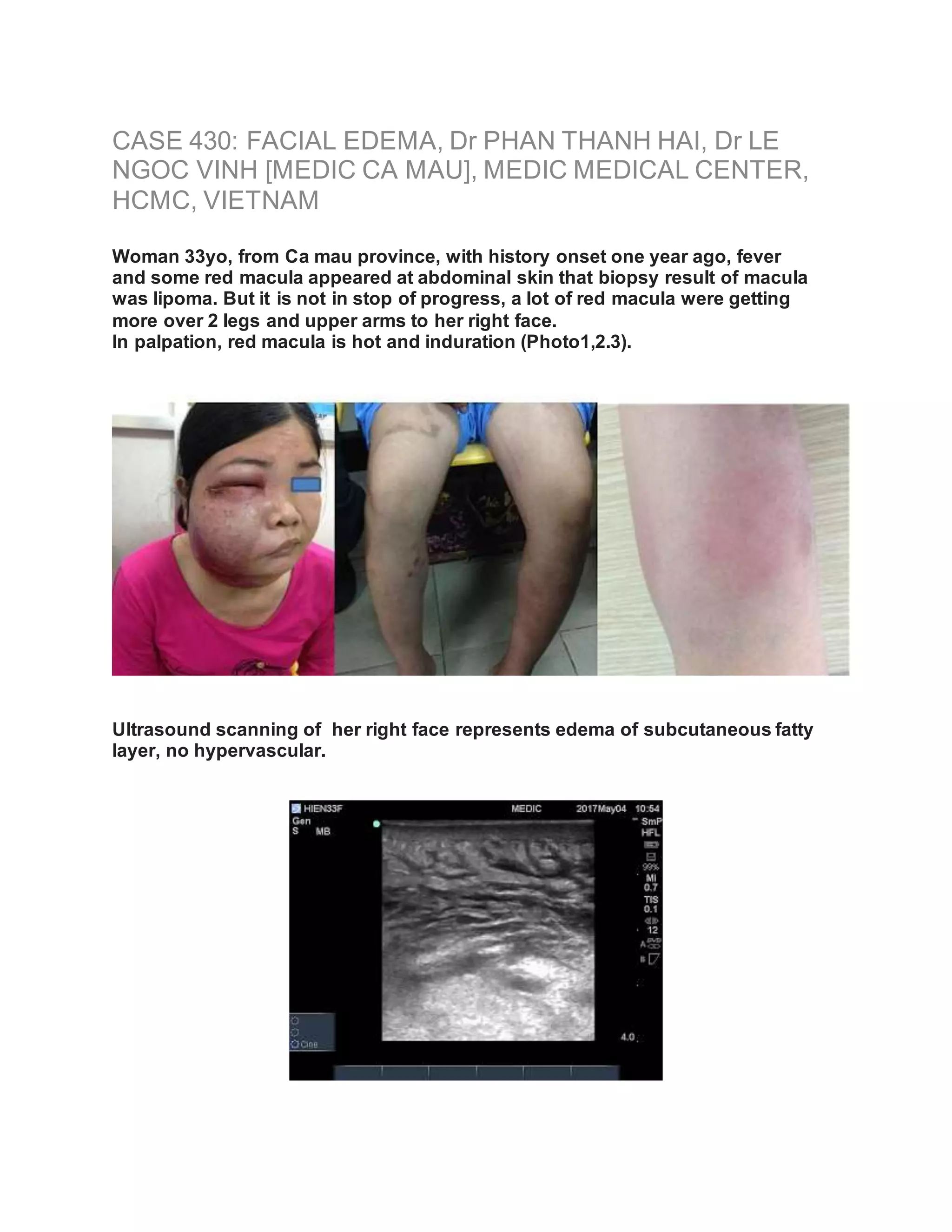 Case 430: FACIAL EDEMA, Dr PHAN THANH HẢI, Dr LÊ NGỌC VINH | DOCX