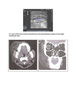 Case 430: FACIAL EDEMA, Dr PHAN THANH HẢI, Dr LÊ NGỌC VINH | DOCX ...