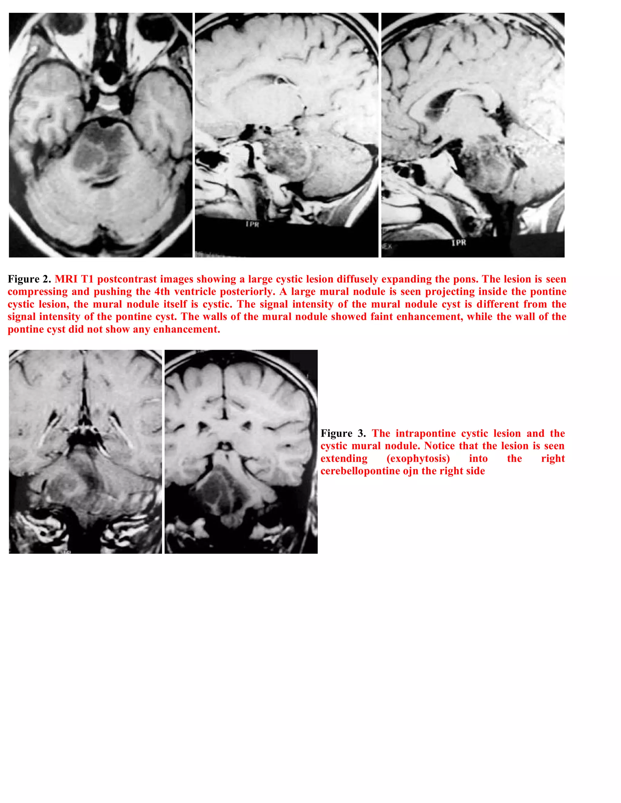 Case record...Brain stem pilocytic astrocytoma | PDF