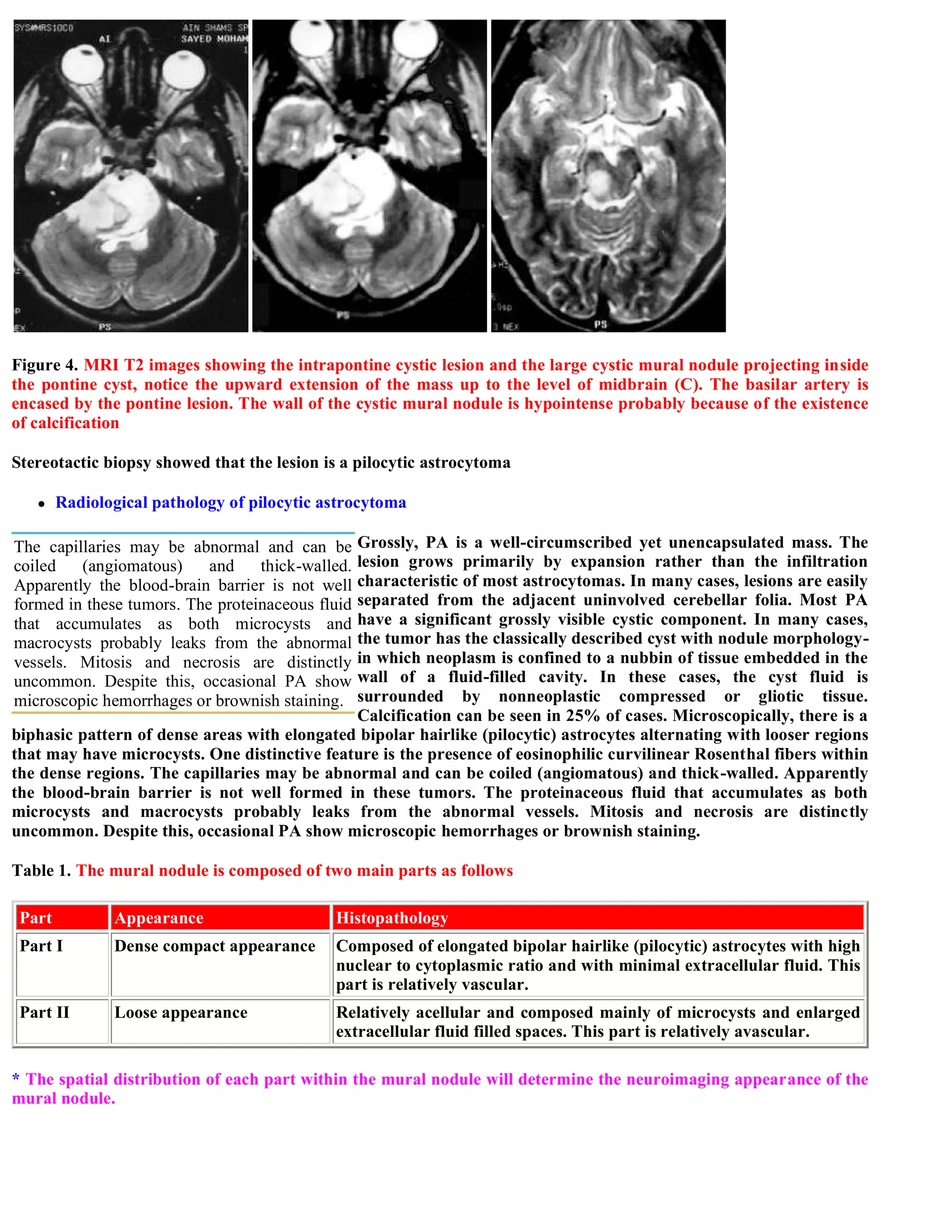 Case record...Brain stem pilocytic astrocytoma | PDF