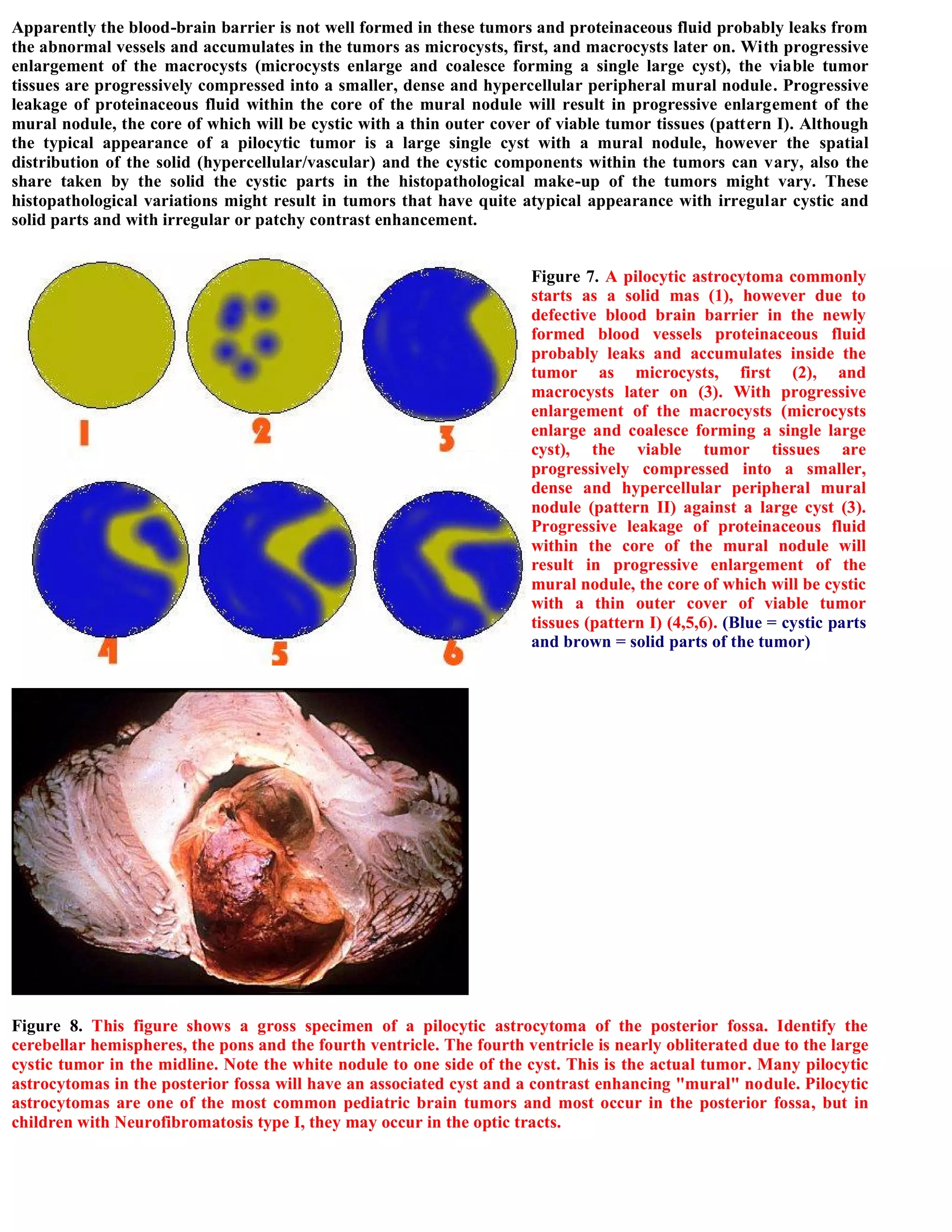 Case Recordbrain Stem Pilocytic Astrocytoma Pdf