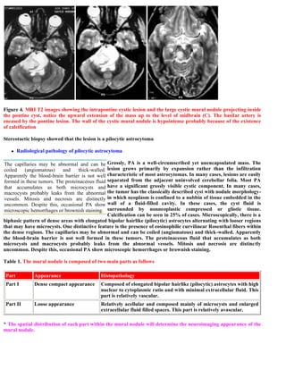 Case record...Brain stem pilocytic astrocytoma | PDF
