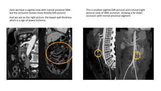 Case 8_ Mesenteric Ischemia choosing the imaging modality .pptx