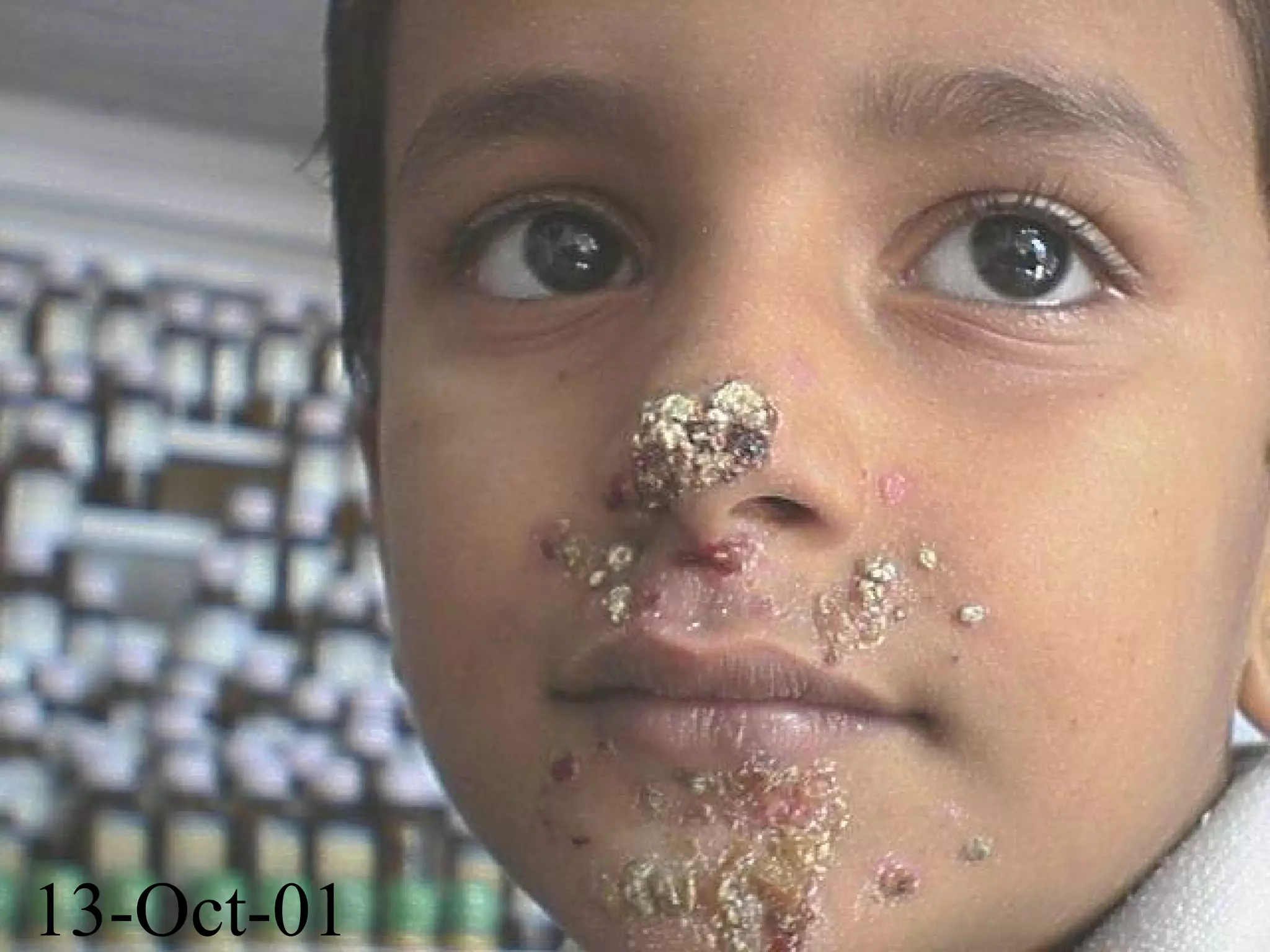Case of Impetigo Contagiosa | PPT