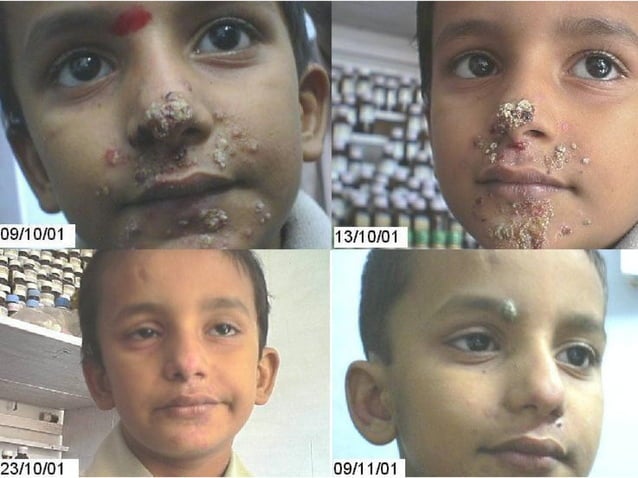 Impetigo Contagiosa | PPT