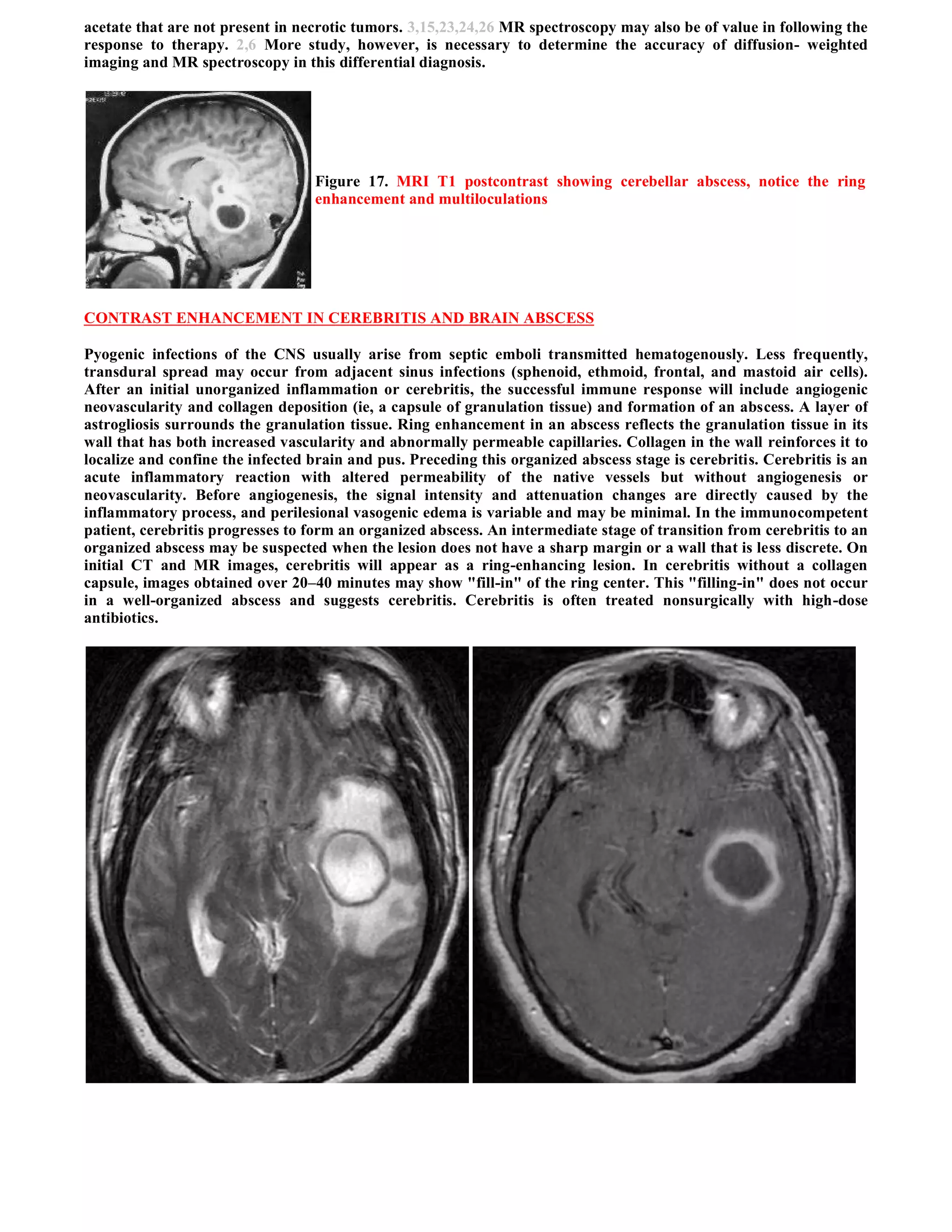 Case record...Multiple pyogenic brain abscesses | PDF