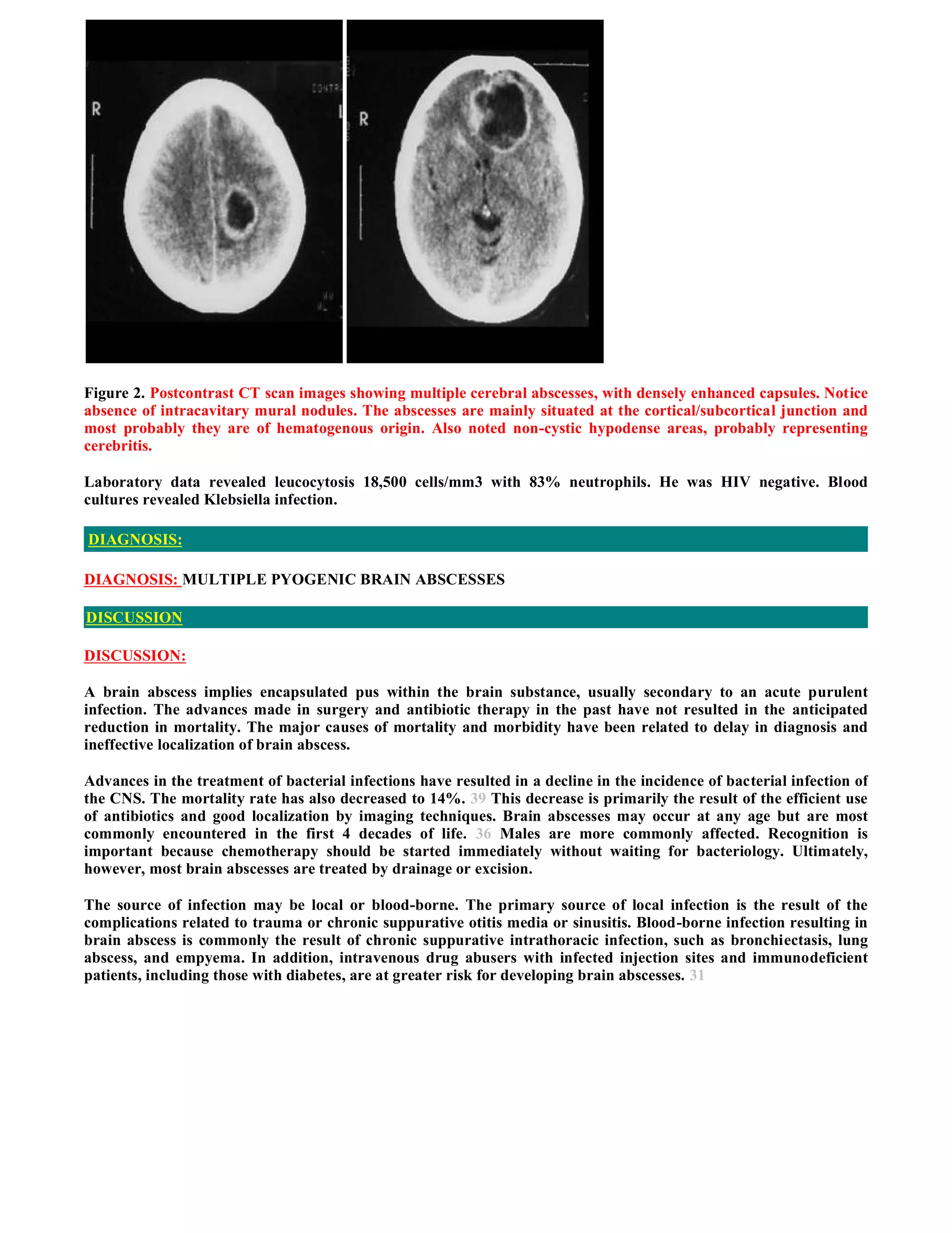 Case record...Multiple pyogenic brain abscesses | PDF