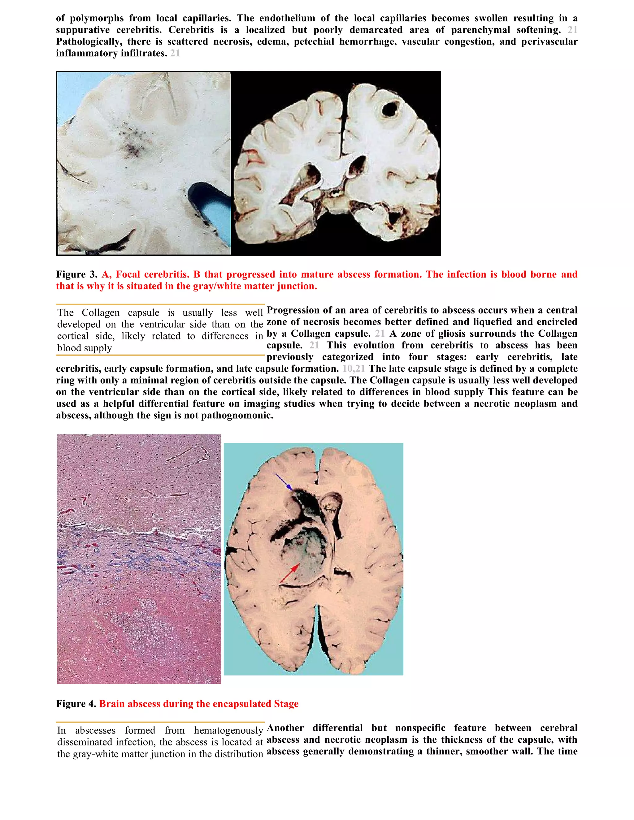 Case record...Multiple pyogenic brain abscesses | PDF