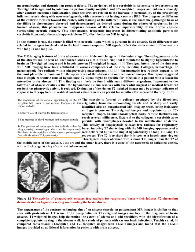 Case record...Multiple pyogenic brain abscesses | PDF