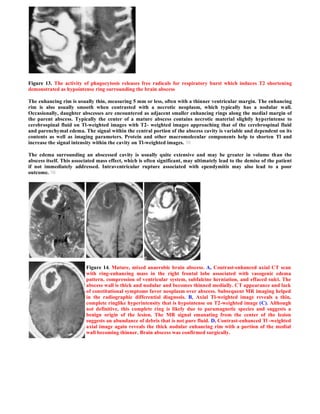 Case record...Multiple pyogenic brain abscesses | PDF