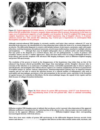 Case record...Multiple pyogenic brain abscesses | PDF