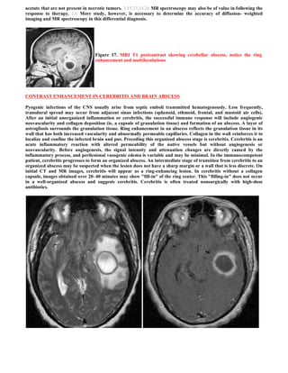 Case record...Multiple pyogenic brain abscesses | PDF