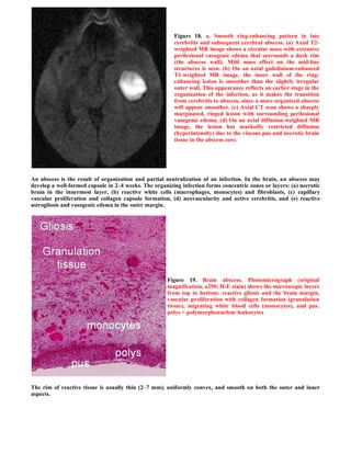 Case record...Multiple pyogenic brain abscesses | PDF