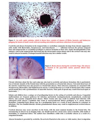 Case record...Multiple pyogenic brain abscesses | PDF