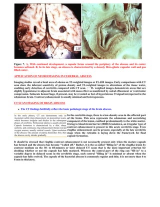 Case record...Multiple pyogenic brain abscesses | PDF