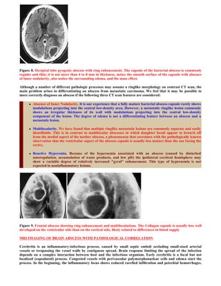 Case record...Multiple pyogenic brain abscesses | PDF