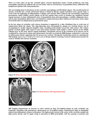 Case record...Multiple pyogenic brain abscesses | PDF