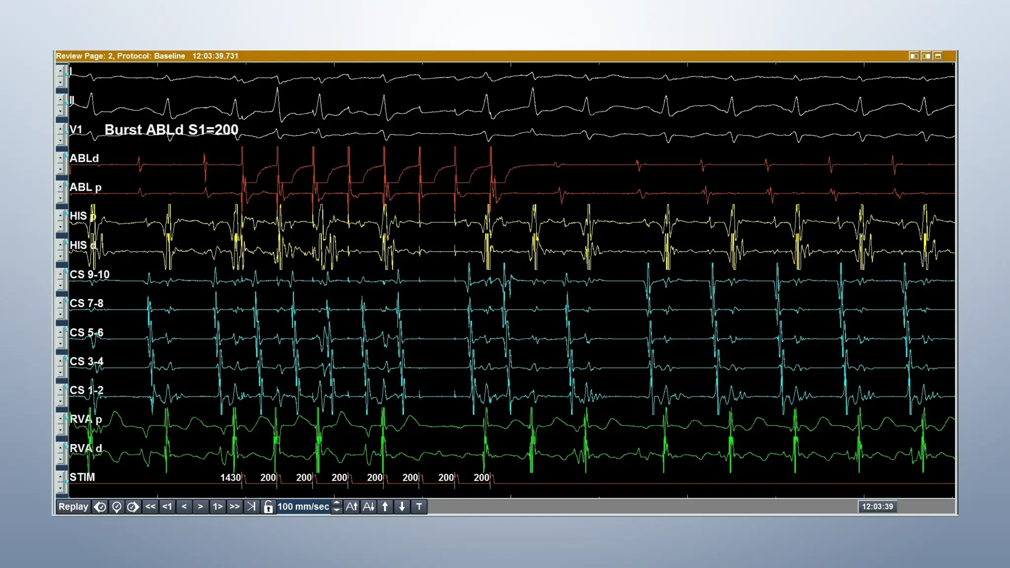 Case discussion of atrioventricular nodal reentry tachycardia | PPTX | Heart and Cardiovascular ...