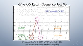 Case discussion of atrioventricular nodal reentry tachycardia | PPTX | Heart and Cardiovascular ...