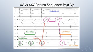 Case discussion of atrioventricular nodal reentry tachycardia | PPTX | Heart and Cardiovascular ...