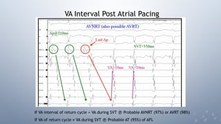 Case discussion of atrioventricular nodal reentry tachycardia | PPTX | Heart and Cardiovascular ...