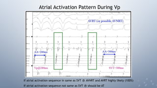 Case discussion of atrioventricular nodal reentry tachycardia | PPTX | Heart and Cardiovascular ...