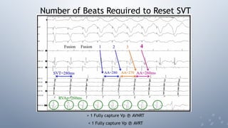 Case discussion of atrioventricular nodal reentry tachycardia | PPTX