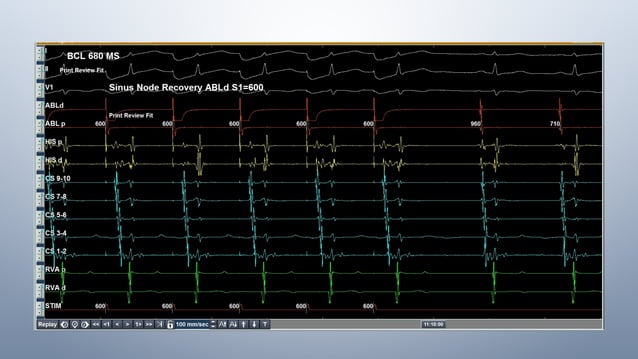 Case discussion of atrioventricular nodal reentry tachycardia | PPTX | Heart and Cardiovascular ...