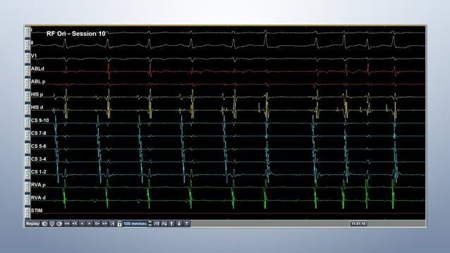 Case discussion of atrioventricular nodal reentry tachycardia | PPTX | Heart and Cardiovascular ...