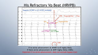Case discussion of atrioventricular nodal reentry tachycardia | PPTX