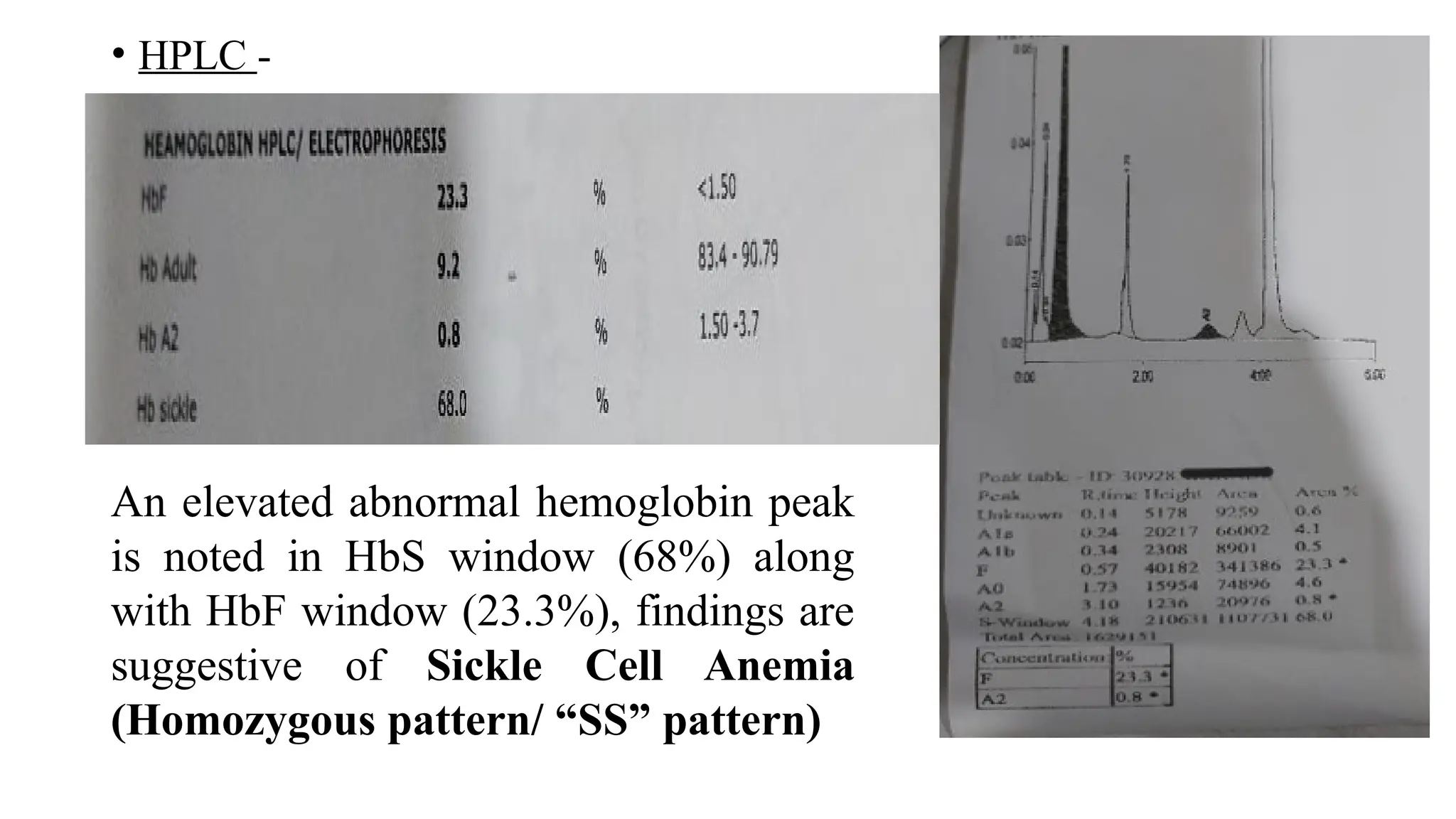 CASE BASED DISCUSSION - HEMOLYTIC JAUNDICE - Areej-2.pptx